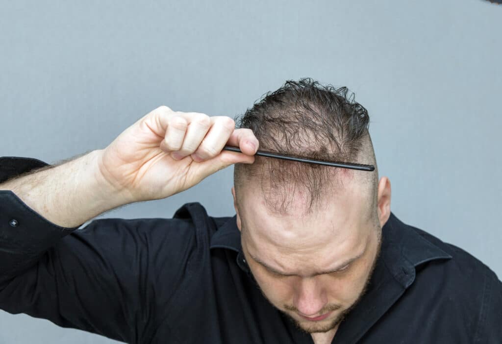 Early Signs of Hair Thinning and When to Seek Treatment